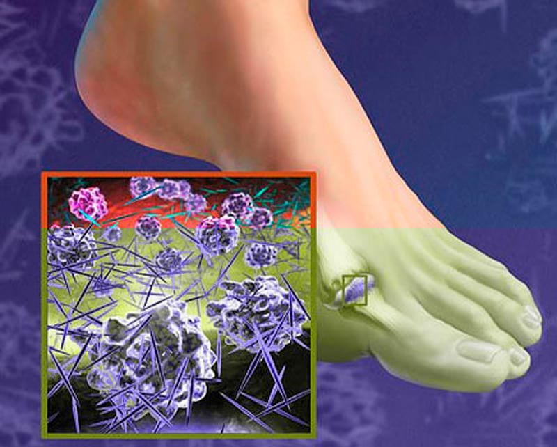 Bolestivé klouby mohou být prvním příznakem, že vás ohrožuje nemoc ...