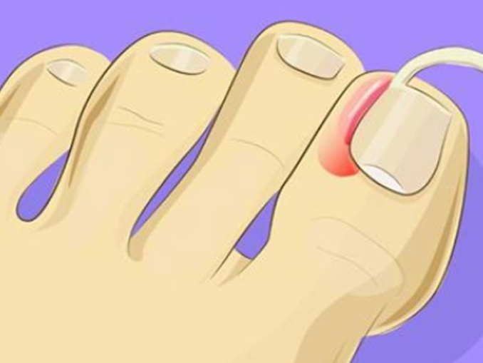 Domácí léčba zarostlého nehtu | Zdravestravovani.eu