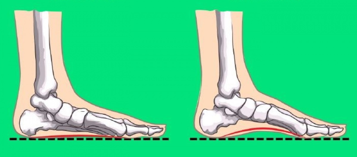 Cvičení na plochou nohu odstraňuje bolesti | Zdravestravovani.eu