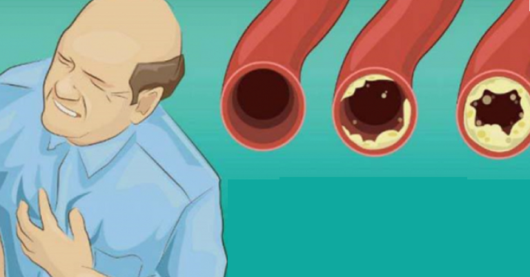 Zařaďte tyto návyky a vyhněte se infarktu | Zdravestravovani.eu