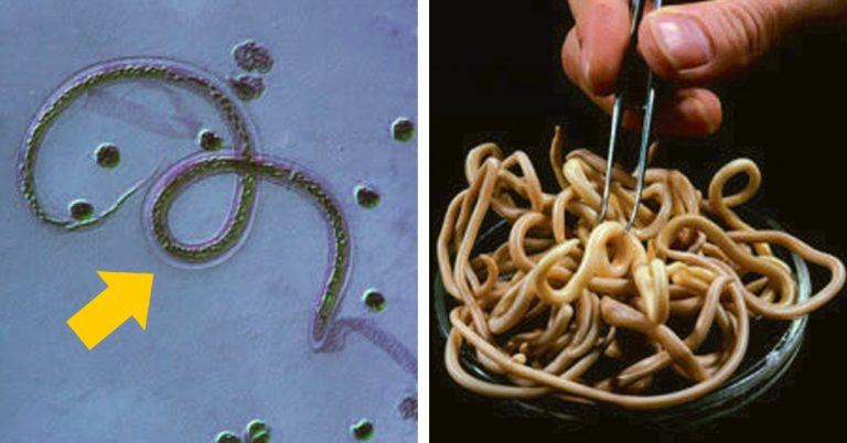 6 parazitů, které můžete mít v těle | Zdravestravovani.eu