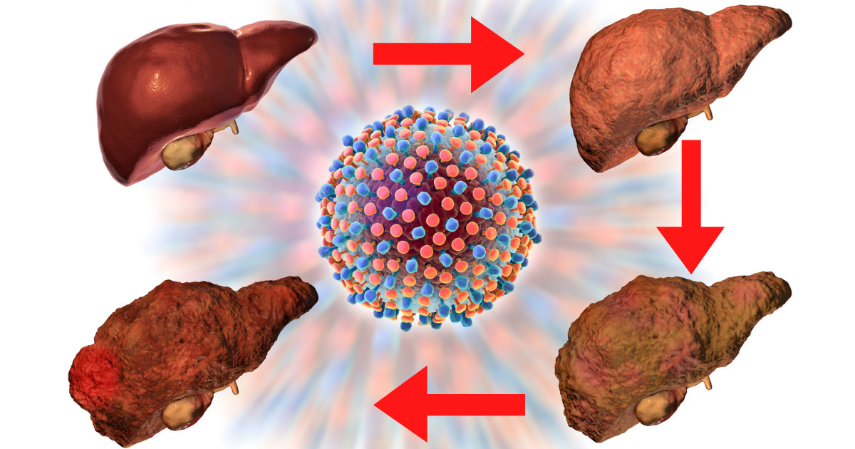Potraviny, které likvidují zdraví jater a vedou k jejich ztučnění