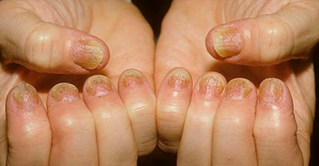 Prevence a léčba psoriázy na nehtech | Zdravestravovani.eu