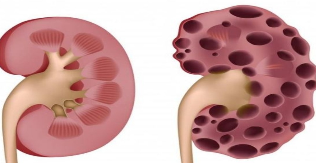 Selhání ledvin se projevuje jasně rozpoznatelnými projevy. Pozor na ně