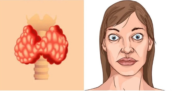 6 nejčastějších onemocnění štítné žlázy: Jak vás ohrožují?