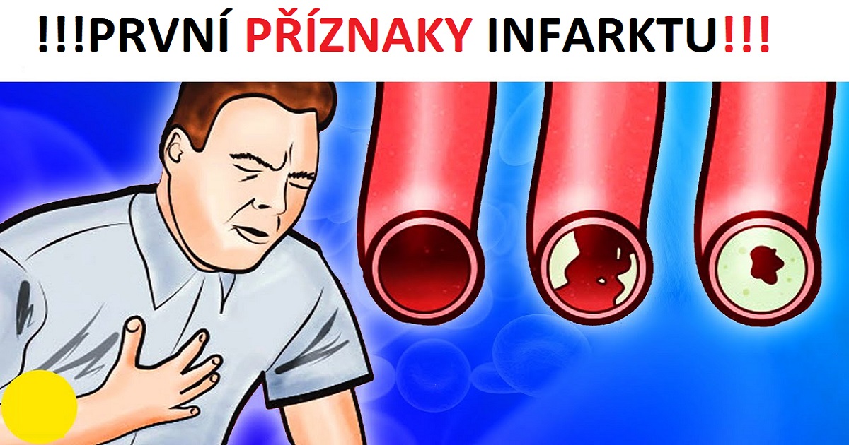První příznaky infarktu poznáte jednoduše. Sledujte zejména tyto