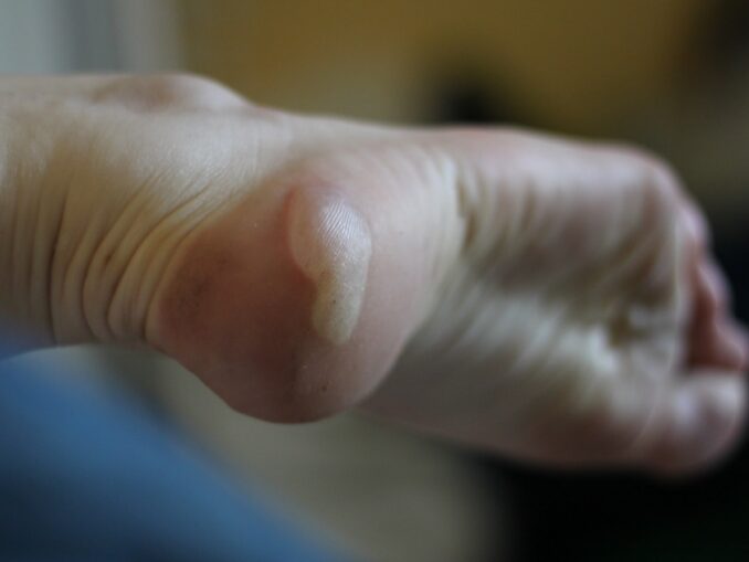 Domácí léčba solnými obklady | Zdravestravovani.eu