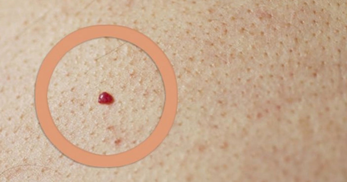 Jak se tvoří angiomy na pokožce a jak se jich snadno zbavit