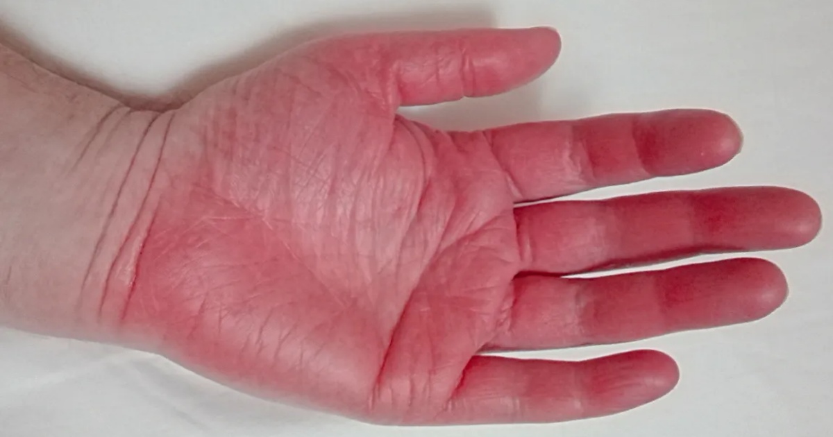 Jaké nejčastější zdravotní potíže indikují nezvykle červené ruce