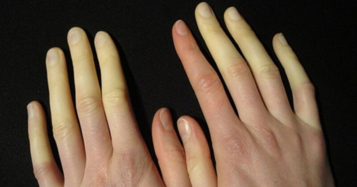 Co je to Raynaudův syndrom a jaké jsou jeho nejčastější příznaky