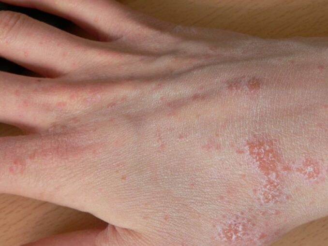 jak se zbavit svrabu - Zdravestravovani.eu