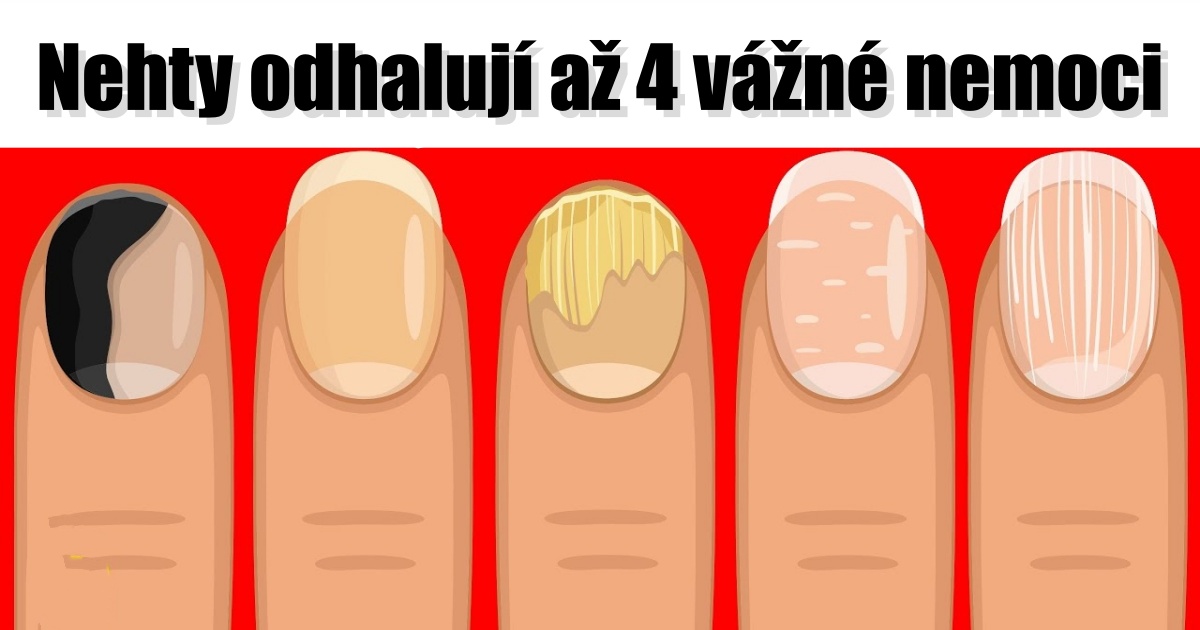 Tajemné výrůstky na nehtech mají ve skutečnosti temný význam