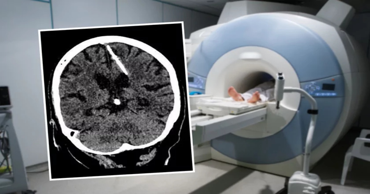 80 leté ženě našli díky rentgenu mozku něco, co nikdy neviděli