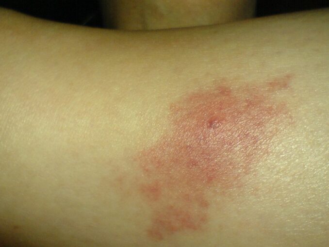 Podle těchto znaků poznáte, který hmyz vás kousnul