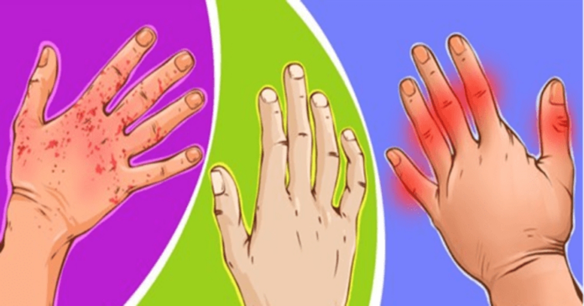 Změna vzhledu a barvy rukou prozradí mnohé o vašem zdraví
