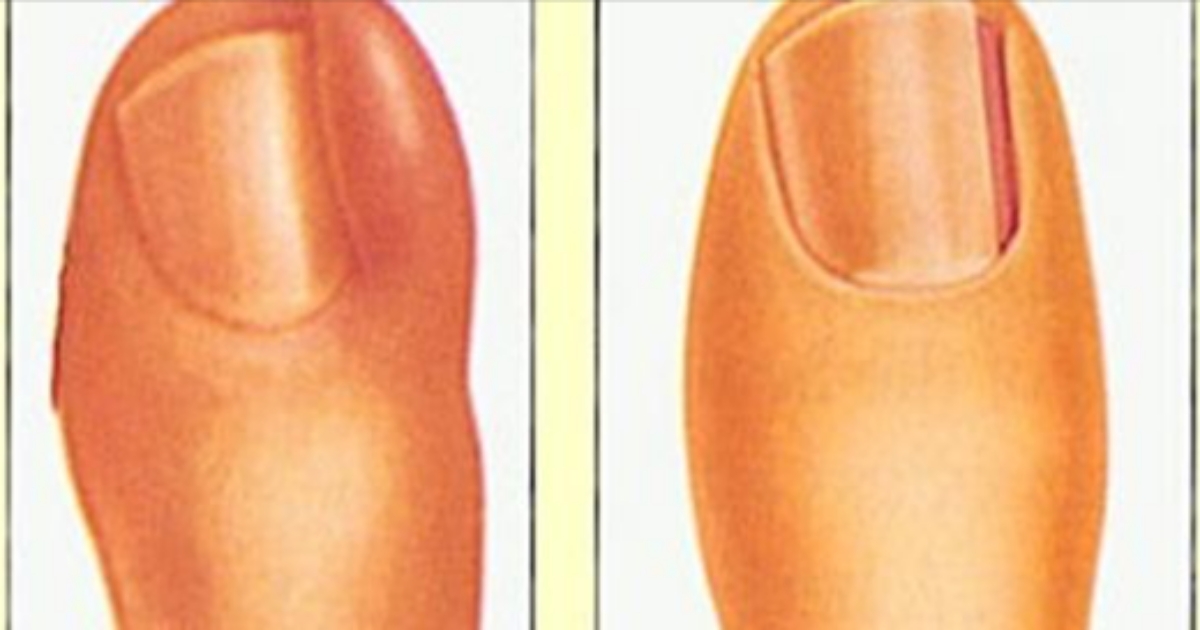 Jak se spolehlivě vypořádat se zarůstajícími nehty na nohách