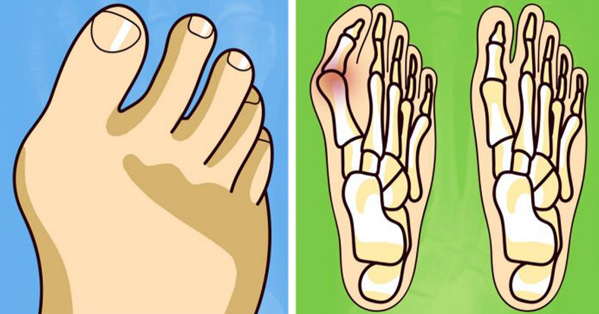 Zbavte se vbočeného palce díky tomuto snadnému domácímu triku