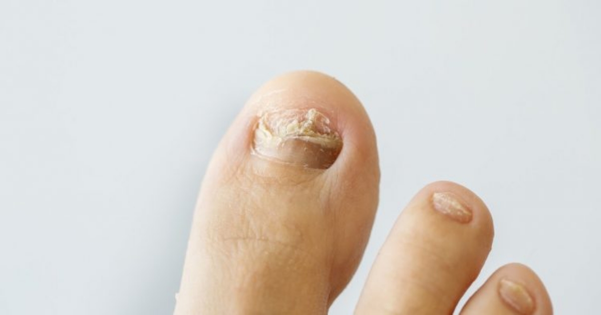 Nepříjemné plísně nehtů mají utrum. Vyzkoušejte tuto domácí fintu