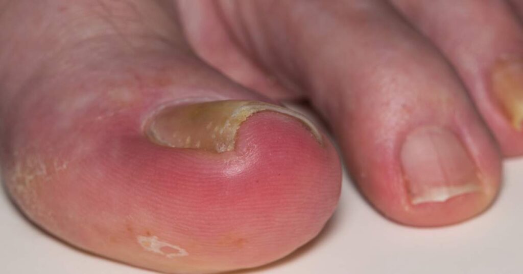 Bílé půlměsíce na nehtech vás mohou upozornit na onemocnění