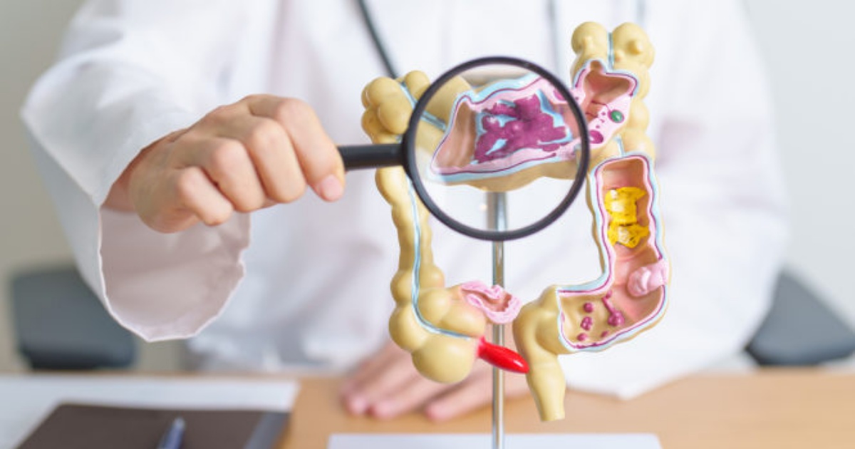 Rakovina konečníku a tlustého střeva a její klíčové příznaky