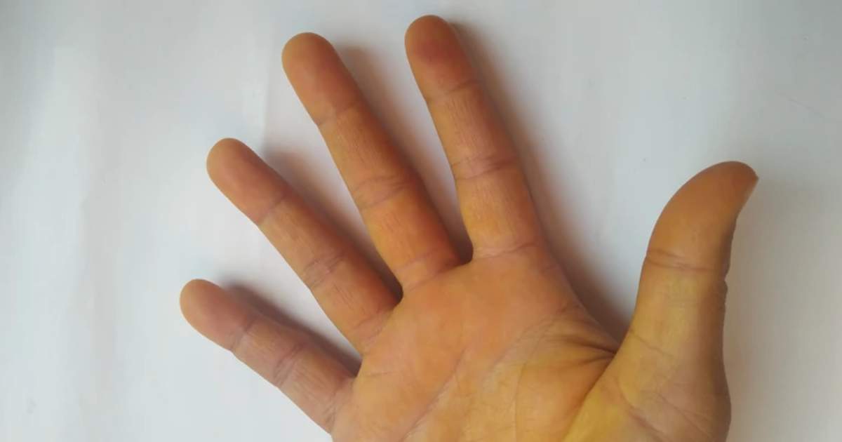 Žloutnutí dlaní a chodidel je skrytý příznak, který přehlíží většina lidí