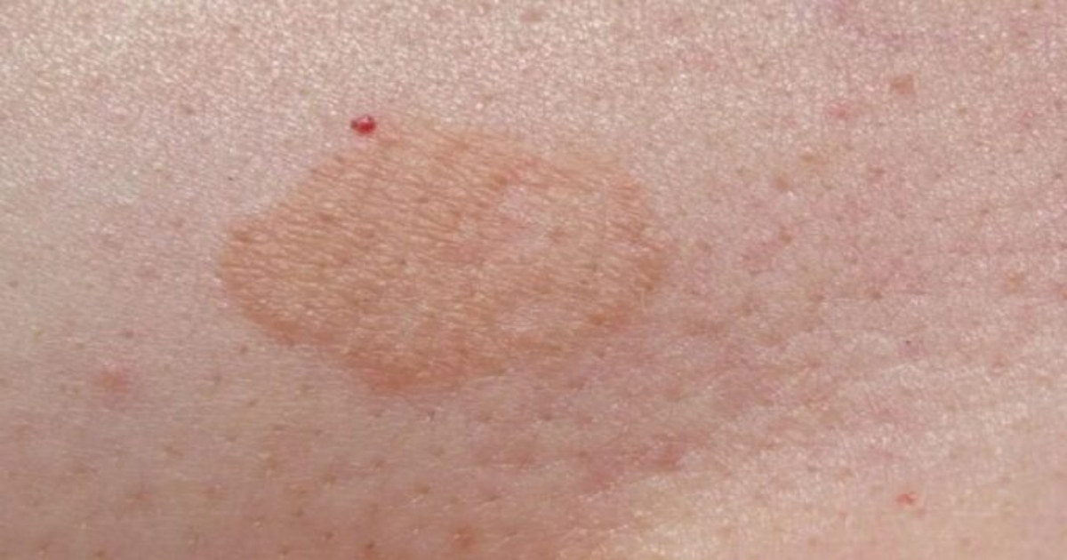 Příznaky přemnožených kvasinek ve střevech: Toto způsobují