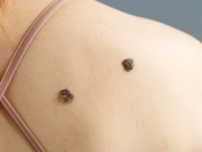 Parestézie: Příčiny a správná léčba | Zdravestravovani.eu