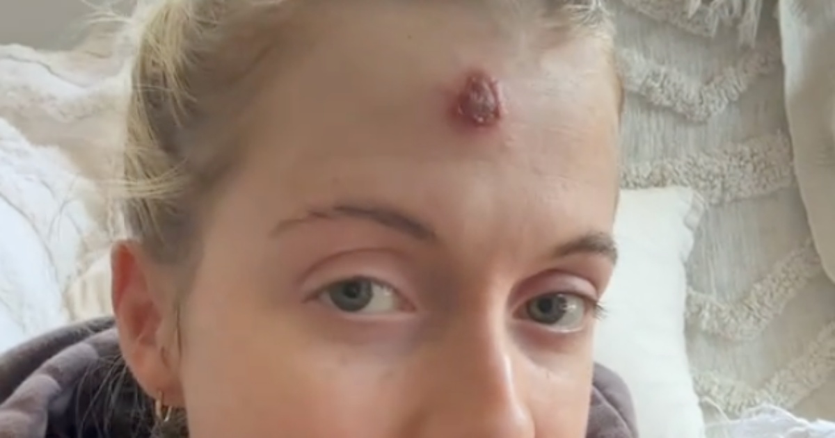 Mladá matka si všimla pupínku. Jednalo se o rakovinu kůže