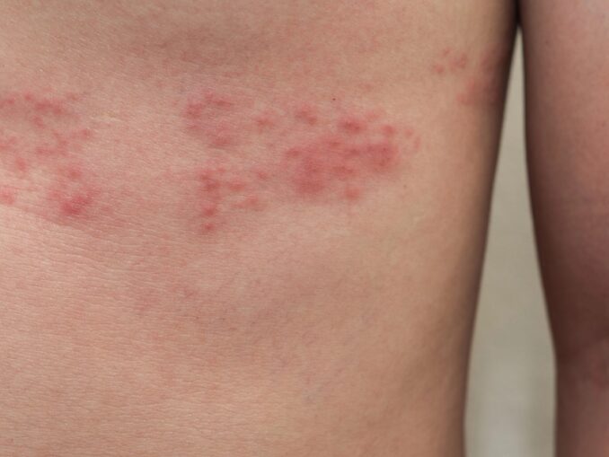 Pásový opar způsobuje spoustu nepříjemností. Nepodceňujte ho